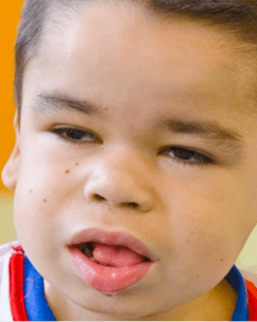 Hunter syndrome (MPS II) Disease Presentation
