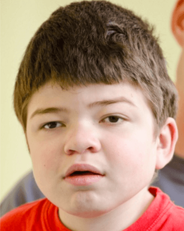 Hunter syndrome (MPS II) Disease Presentation